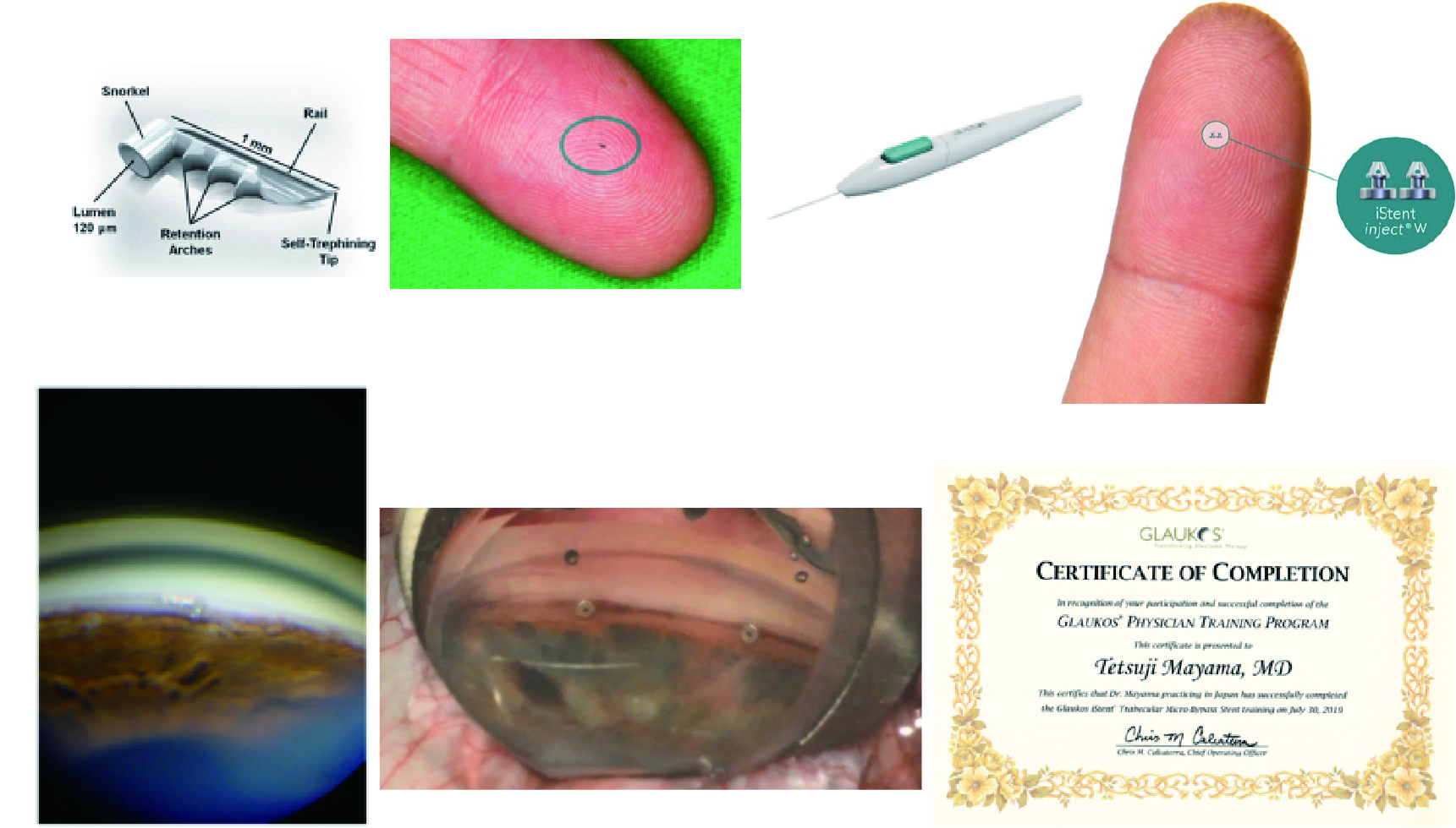 低侵襲緑内障手術【MIGS】 | まやま眼科｜新潟市の眼科医院